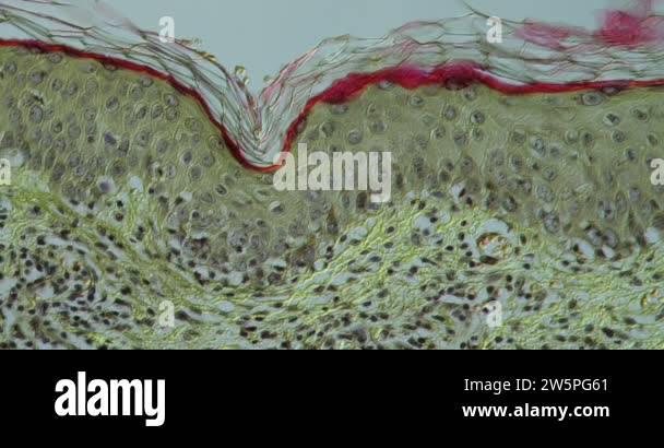 Infection of the skin with Herpes zoster tissue under the microscope ...