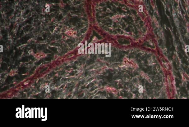 Fibroaddenoma tissue in Darkfield tissue under the microscope 200x ...