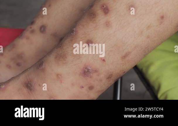 Close up of foot with ulcer filled with pus condition caused of scabies ...