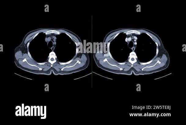 CT Chest or CT Lung axial view soft tissue and lung window for ...
