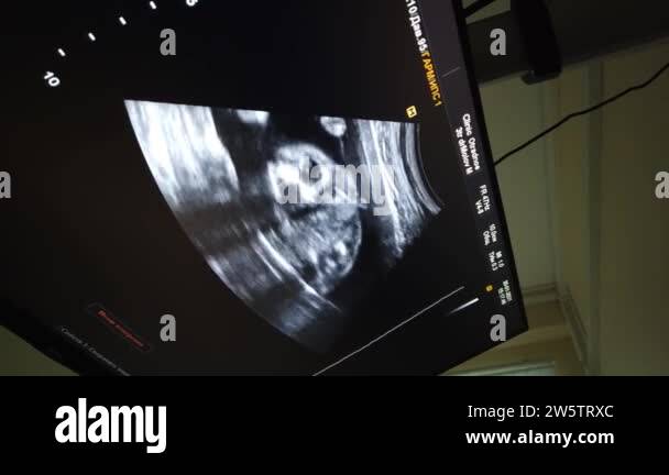 Medical ultrasound scanning, baby silhouette on the screen. Ultrasound ...