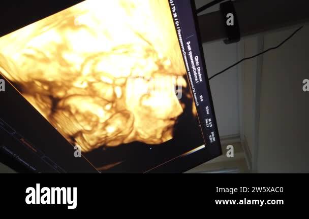 Medical ultrasound scanning, baby silhouette on the screen. Ultrasound ...