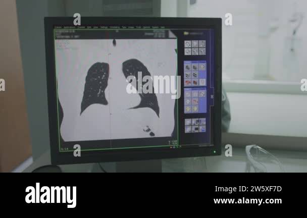 The result of a scan of the lungs on a computed tomograph. Lung model on a computer screen. CT ...