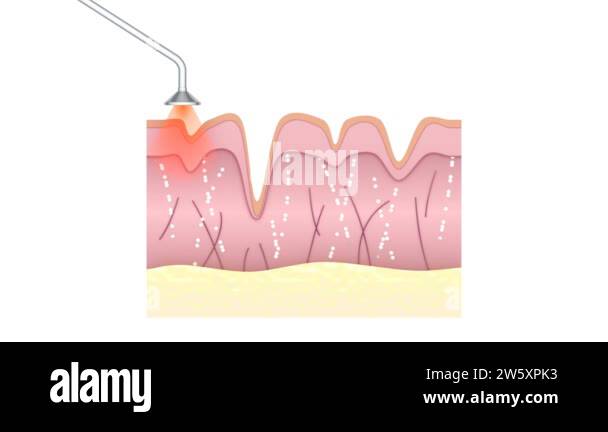 Laser skin rejuvenation. Medical animation showing cosmetology laser ...