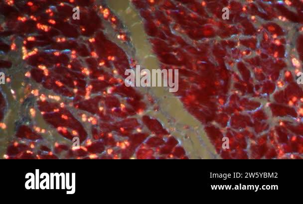 Myocarditis heart in Darkfield tissue under the microscope 200x Stock ...