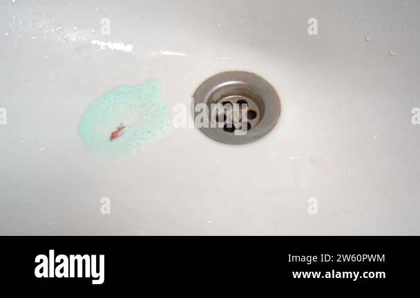 Toothpaste With Blood in the Sink. Blood When Brushing Teeth Stock ...