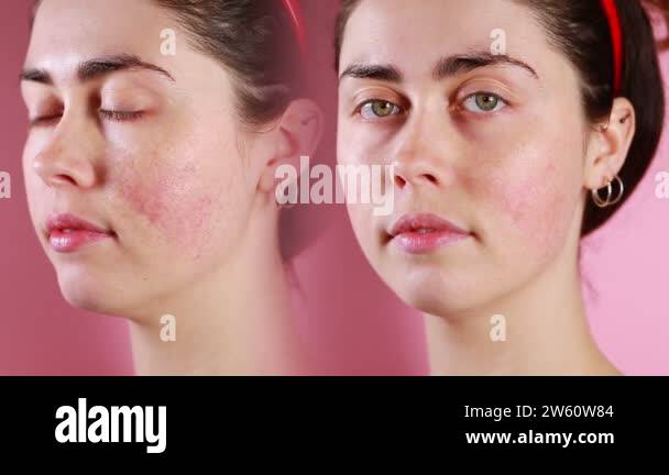 Two faces of a young caucasian woman in close-up showing the result before and after rosacea ...