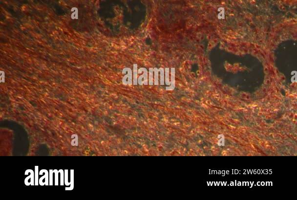 Prostate hypertrophy in Darkfield tissue under the microscope 200x ...