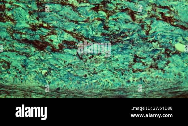 large intestine diseased tissue under the microscope 100x Stock Video ...