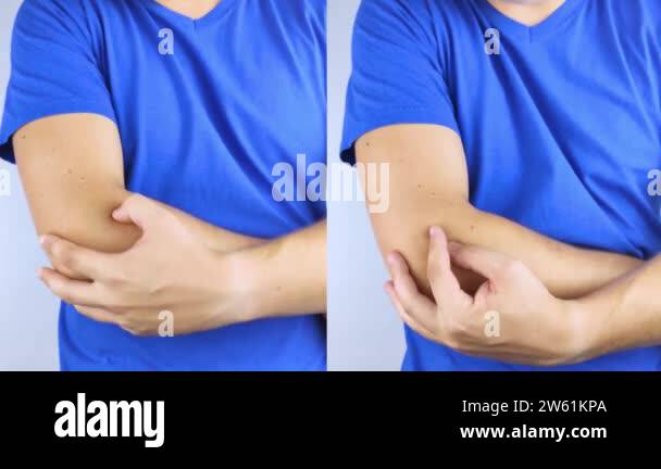 Before and after. On left man is holding onto his injured elbow. On ...