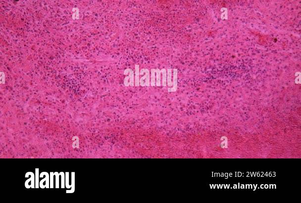 Sarcoma cells Stock Videos & Footage - HD and 4K Video Clips - Alamy