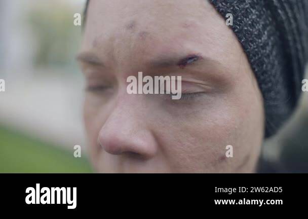 Dizzy woman with wound on the face, substance abuse, drug intoxication ...