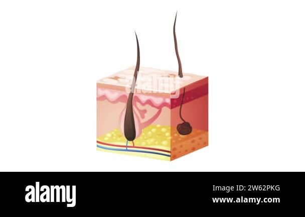 A cutout skin layers, structures, veins in details that shows a wart ...