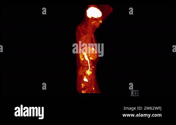 PET CT ( Positron Emission Tomography ) of whole human body 3d ...