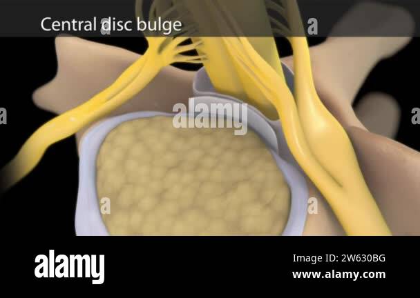 Cervical disc protrusion Stock Videos & Footage - HD and 4K Video Clips ...
