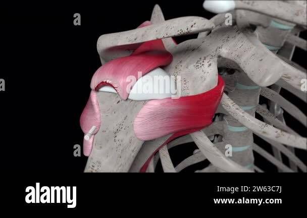 This 3d animation shows the shouder surgery with one anchor suture of ...