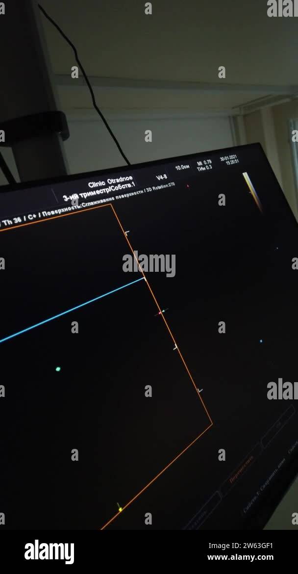 Medical ultrasound scanning, baby silhouette on the screen. Ultrasound ...