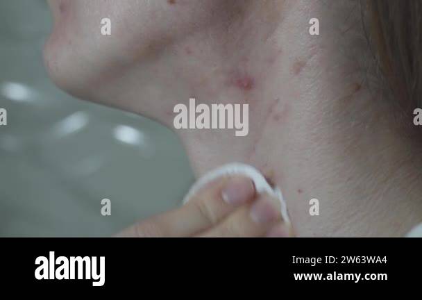 Girl cleaning the skin with a sponge on the neck. Oily skin of a woman ...