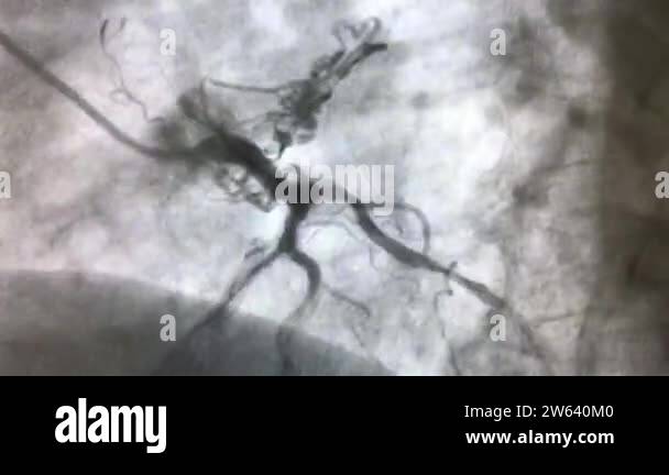 Heart coronary artery angiogram Stock Videos & Footage - HD and 4K ...