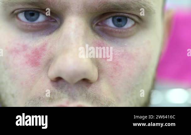 Purpura rash Stock Videos & Footage - HD and 4K Video Clips - Alamy