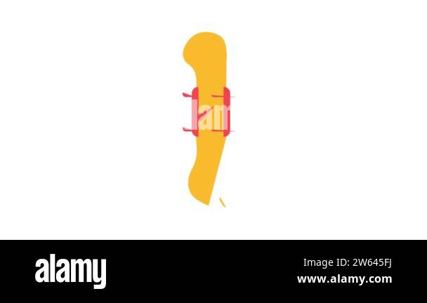 Fracture bone Stock Videos & Footage - HD and 4K Video Clips - Alamy