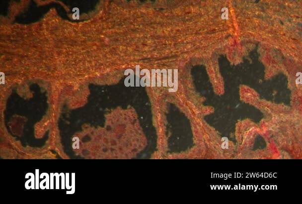 Prostate hypertrophy in Darkfield tissue under the microscope 100x ...