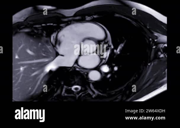 MRI heart or Cardiac MRI ( magnetic resonance imaging ) of heart in ...
