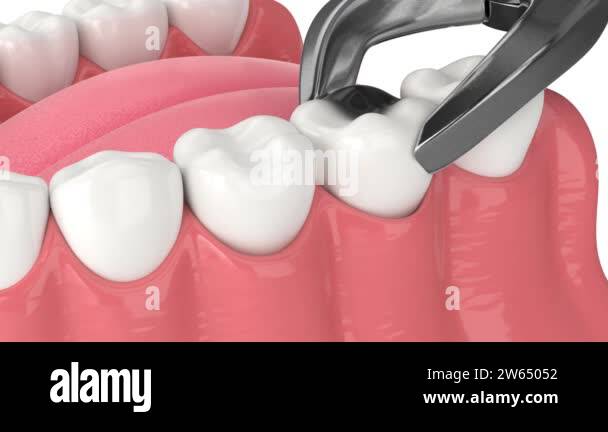 Bone grafting material Stock Videos & Footage - HD and 4K Video Clips ...