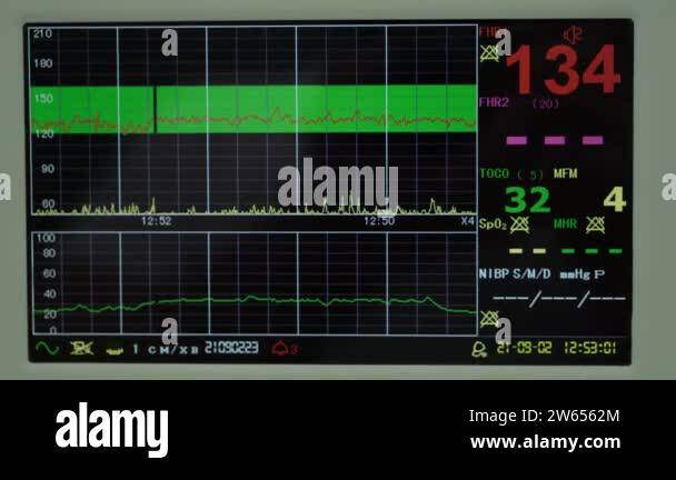 Electronic Cardiotocography Machine Monitoring Fetal Heart Contractions ...
