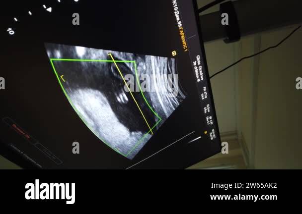 Medical ultrasound scanning, baby silhouette on the screen. Ultrasound ...