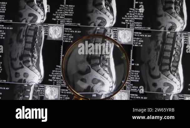 Mri Lumbar Spine Background Magnetic Resonance Tomography Doctor Examines Mri Of Lumbar Spine