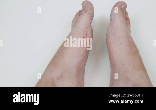 Painful rash, red blisters on a mans leg. Human legs with dermatitis ...