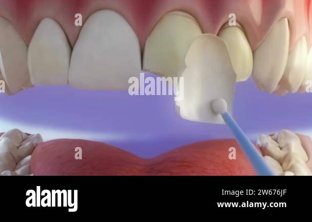 Tooth coating Stock Videos & Footage - HD and 4K Video Clips - Alamy