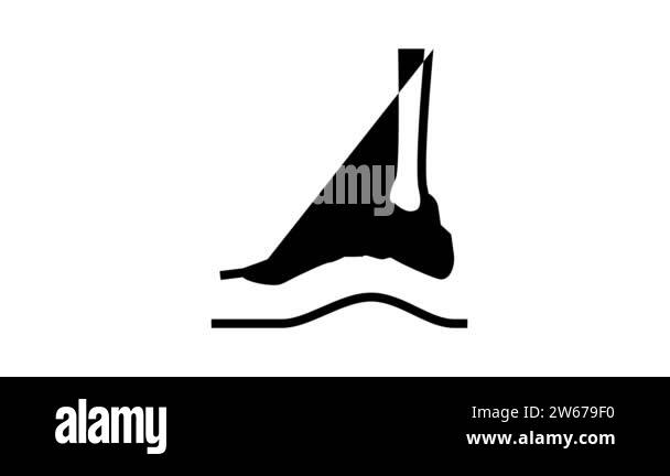 Bone deformity Stock Videos & Footage - HD and 4K Video Clips - Alamy