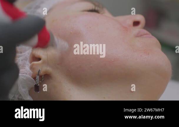 Close-up of a woman face. Needle mesotherapy procedure into the skin of ...