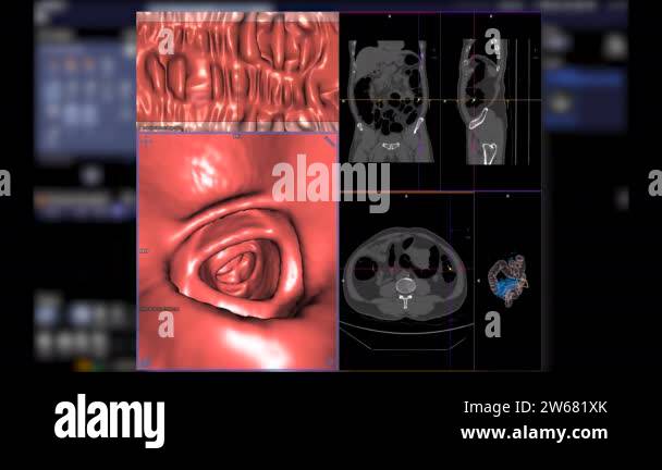 CT colonography compare Axial ,Coronal ,sagittal and 3D rendering movie ...