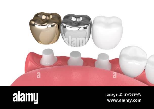 Teeth in jaw with three different types of dental crown filling Stock ...