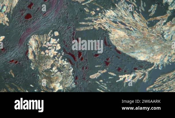 gout tissue crystals under the microscope 100x Stock Video Footage - Alamy