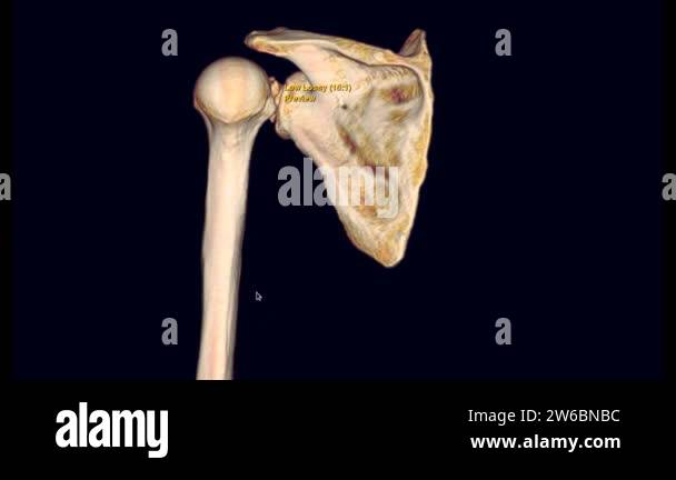 Shoulder ct scan Stock Videos & Footage - HD and 4K Video Clips - Alamy Shoulder ct scan Stock Videos & Footage - HD and 4K Video Clips - Alamy