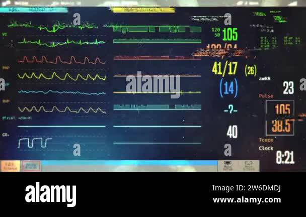 Glitching ICU monitor screen with patient's vital signs, paranormal ...