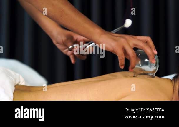 Glass cup fire cupping treatment Stock Videos & Footage - HD and 4K ...