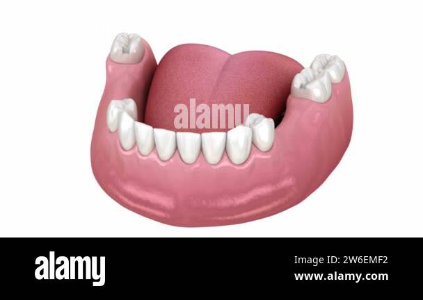 Removable partial denture, mandibular prosthesis. Medically accurate 3D ...