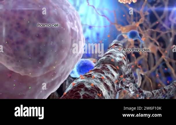 Multiple Myeloma is a type of cancer that consists of a type of white ...