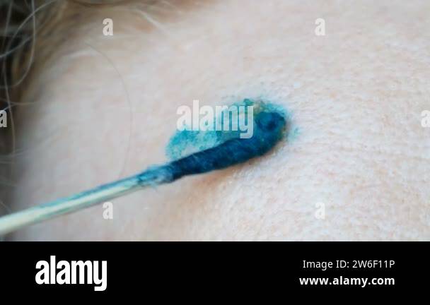 treating a small wound on a woman's face with an antiseptic, macro ...