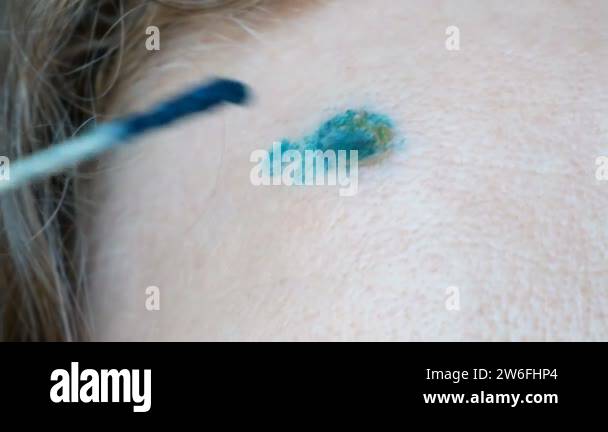 treating a small wound on a woman's face with an antiseptic, macro ...