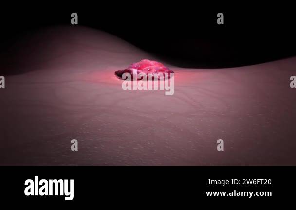 Vascular birthmarks are made up of blood vessels that havent formed ...