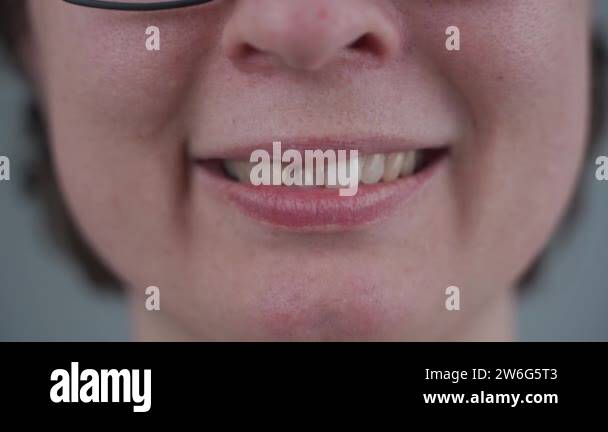 Topic restoration teeth after chips, trauma and damage. Close-up ...