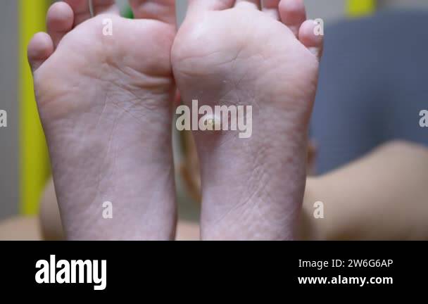 Callus and Wart Feet on Plantar Flat foot in Child. Flat feet. Close-Up ...