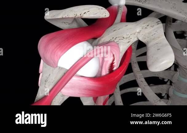 This 3d medical animation shows a shouder labral tear with surgical ...
