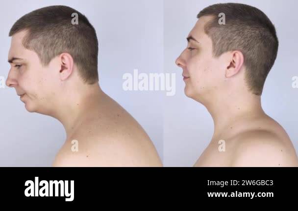 Before and after kyphosis. The man suffers from a curvature of the ...